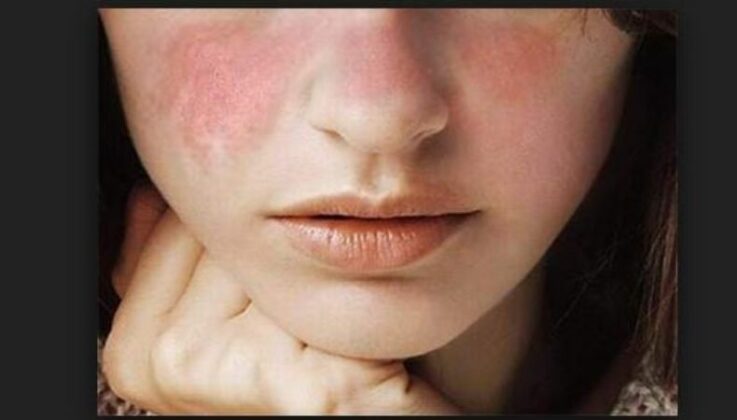 ¿Sabía usted que el lupus afecta más a las mujeres?